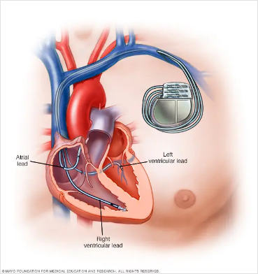 Pacemaker insertion